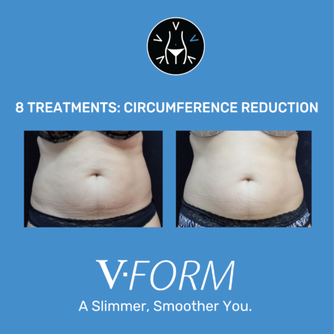 VIORA LASER | Fig Medical Spa