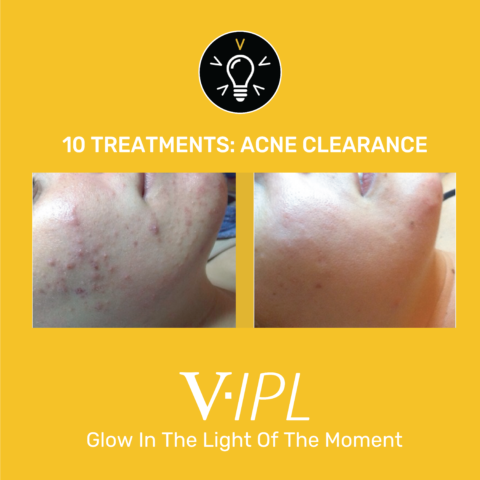 VIORA LASER | Fig Medical Spa