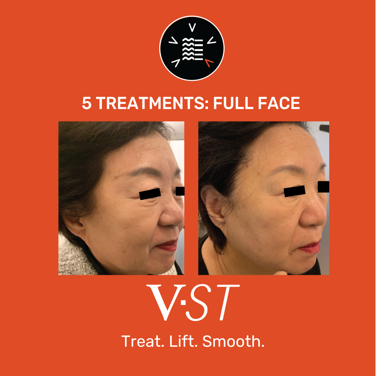 VIORA LASER | Fig Medical Spa