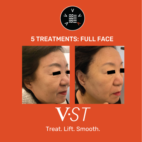 VIORA LASER | Fig Medical Spa