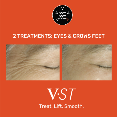 VIORA LASER | Fig Medical Spa