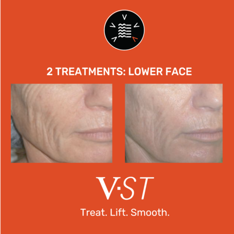 VIORA LASER | Fig Medical Spa