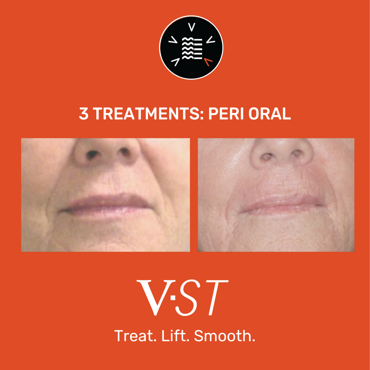 VIORA LASER | Fig Medical Spa