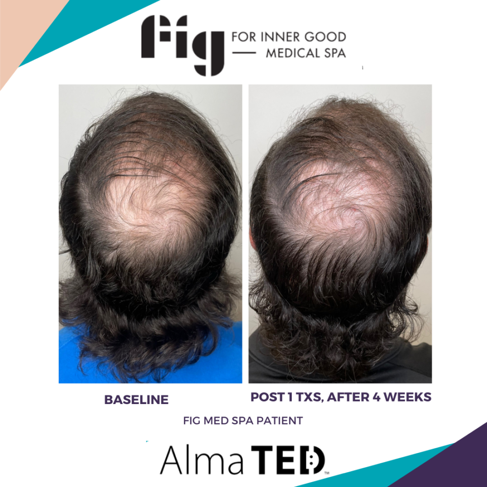 TED HAIR RESTORATION | Fig Medical Spa